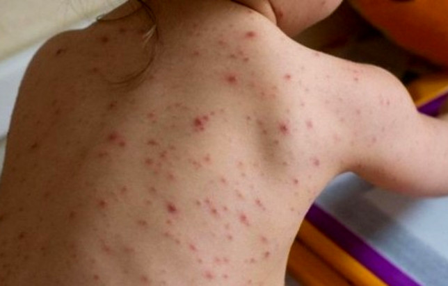 Pericol major! Încă 76 de cazuri de rujeolă, confirmate în ultima ...